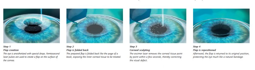 LASIK | Adelaide Eye & Laser Centre