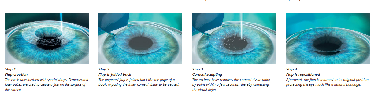 Types of Eye Laser Surgery | Adelaide Eye & Laser Centre