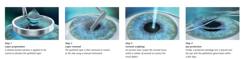 Types of Eye Laser Surgery | Adelaide Eye & Laser Centre