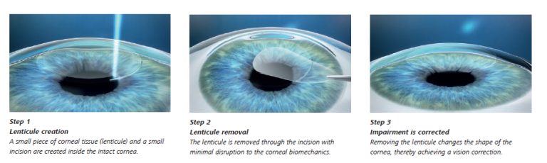 SMILE® Pro | Adelaide Eye & Laser Centre